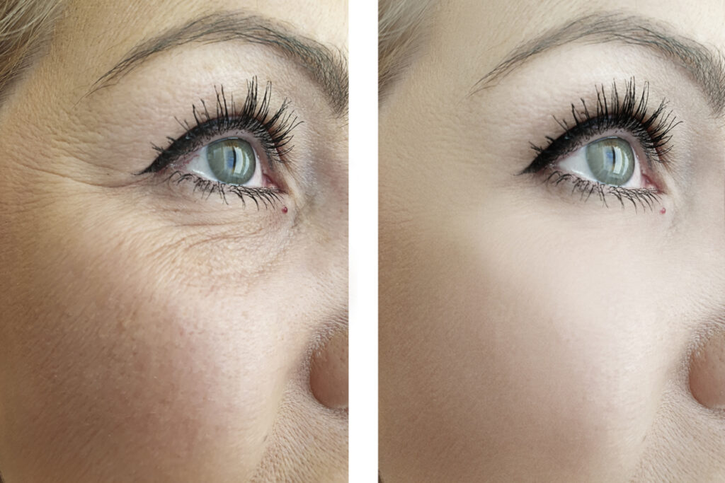 Laser Treatments - Reveal MedSpa